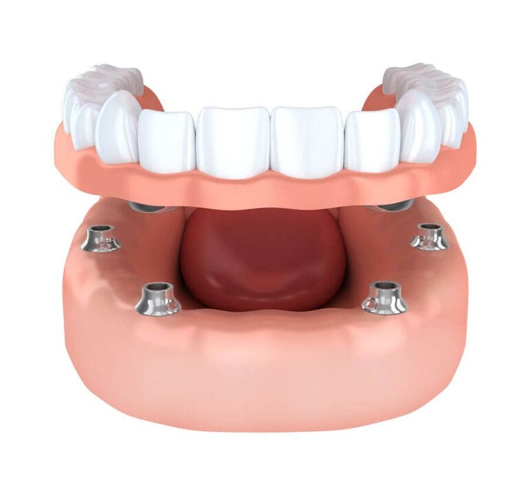 Implant Retained Overdentures | The Aubrey Dentist